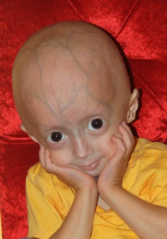 Group Of Progeria Kids